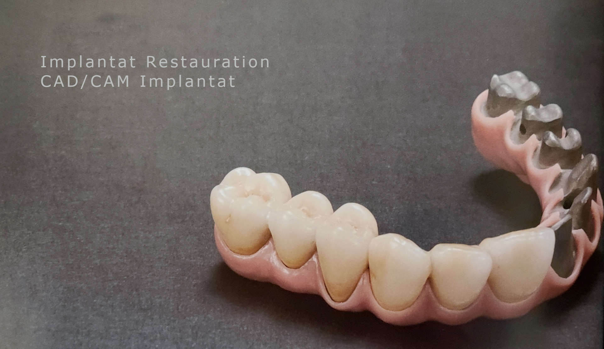 Implantate Archive - ViviDenti Zahnersatz