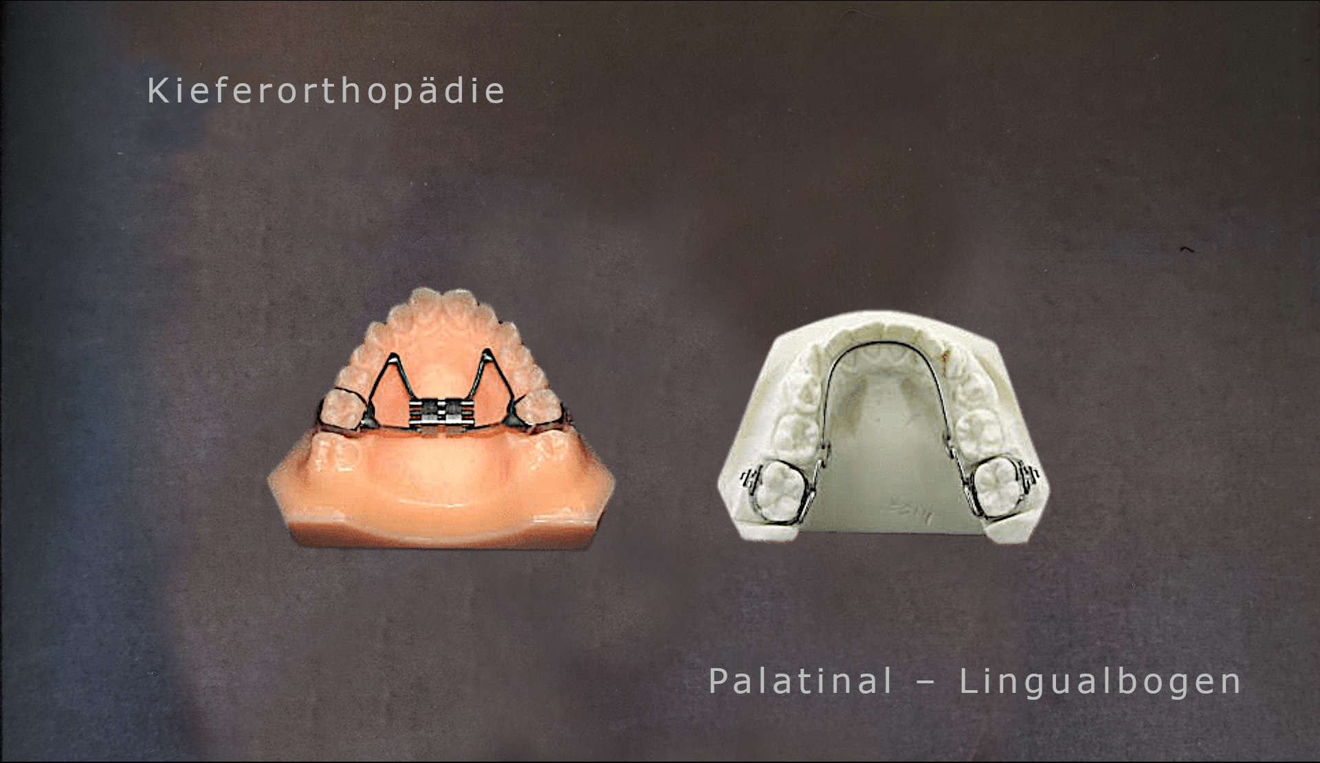 Palatinal Lingualbogen - ViviDenti Zahnersatz