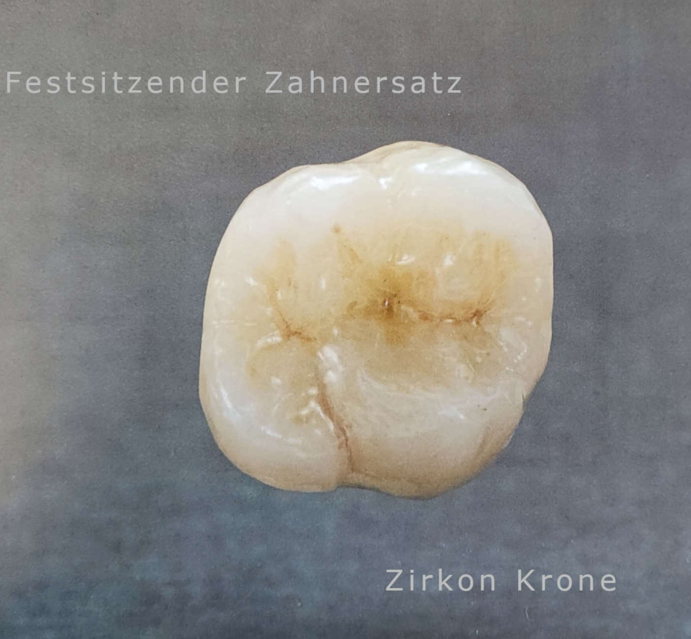 Zirkonkronen & Brücken ersetzen fehlende Zähne sicher