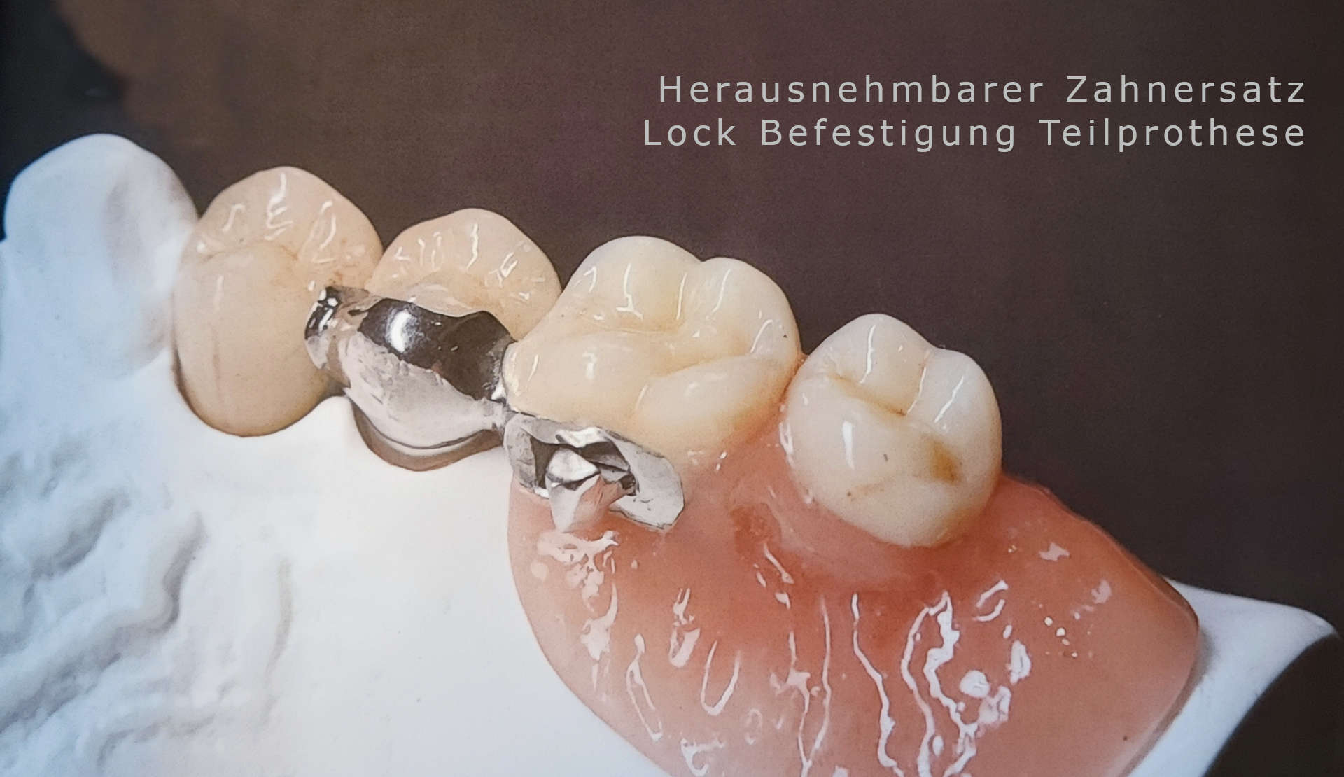 Verriegeln oder Entrieglen Sie Prothese - ViviDenti Zahnersatz